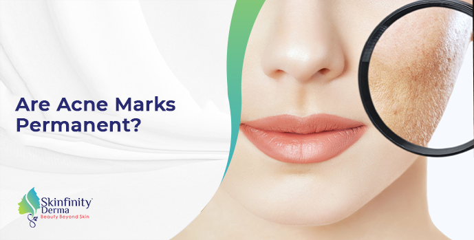 Are Acne Marks Permanent?