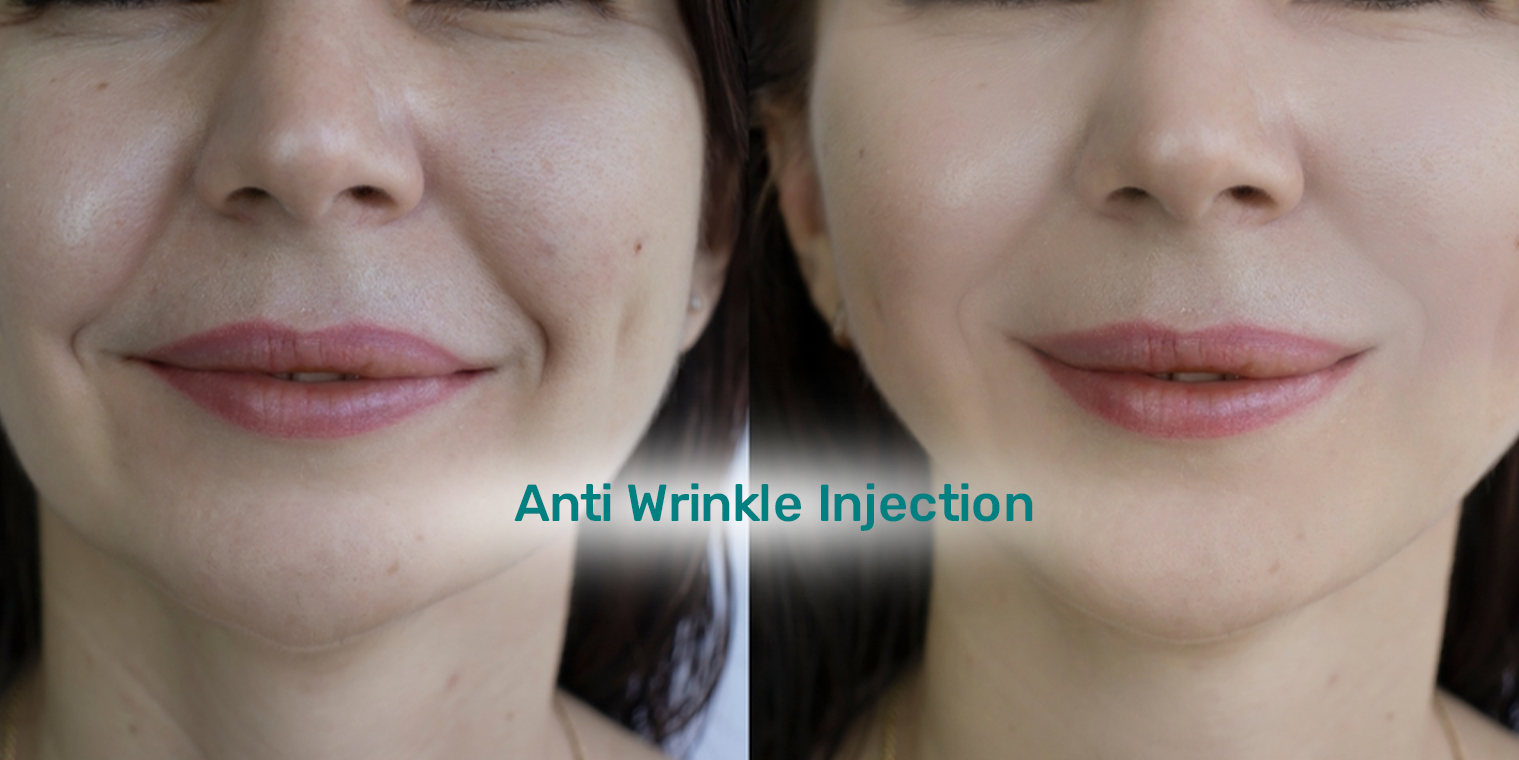 HIFU in Noida | HIFU Clinic in Noida - Skinfinity Derma